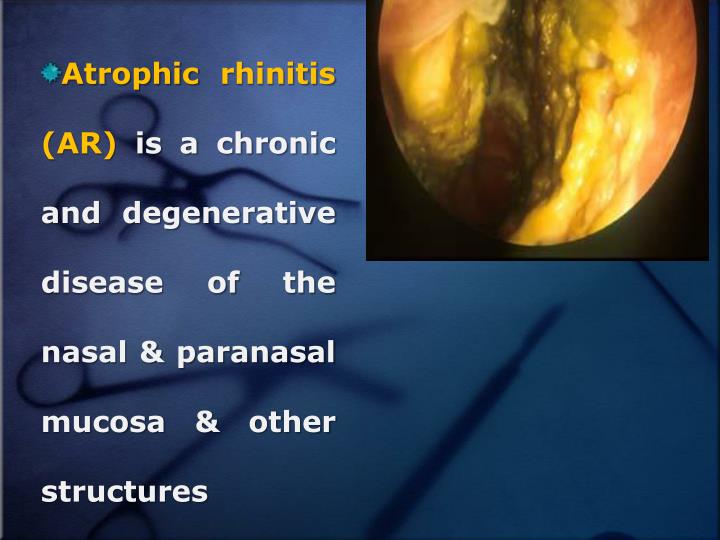 PPT - Atrophic Rhinitis ’ Ozena ’ PowerPoint Presentation - ID:6237493