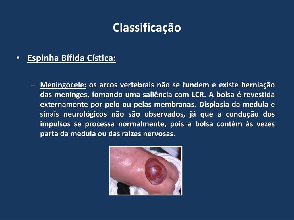 PPT - ESPINHA BÍFIDA OU MIELODISPLASIA PowerPoint Presentation, free ...