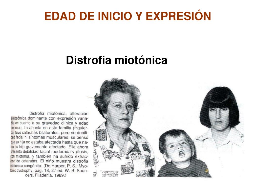 PPT - Deformidad de la mano hendida (70% penetrancia) PowerPoint ...