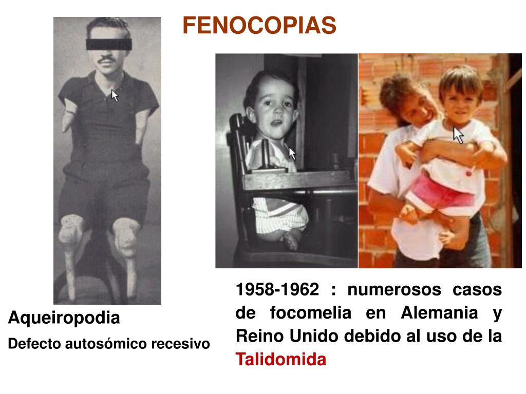 PPT - Deformidad de la mano hendida (70% penetrancia) PowerPoint ...
