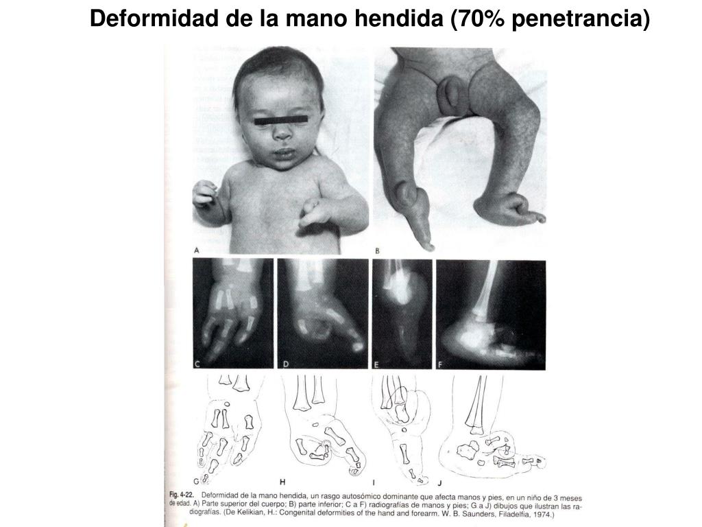 PPT - Deformidad de la mano hendida (70% penetrancia) PowerPoint ...