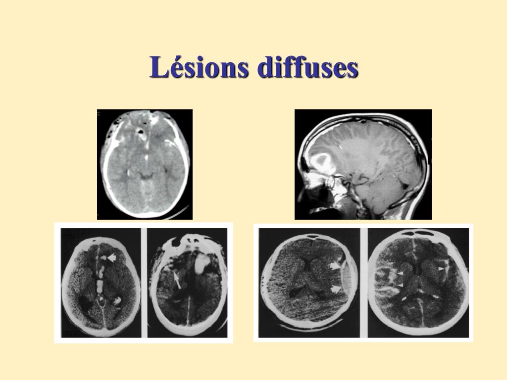 PPT - Les traumatismes graves de l’enfant: épidémiologie PowerPoint ...