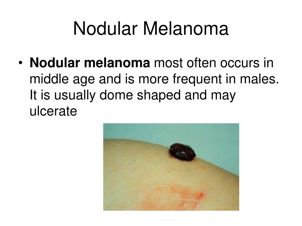 PPT - Skin Cancer PowerPoint Presentation, free download - ID:6252003