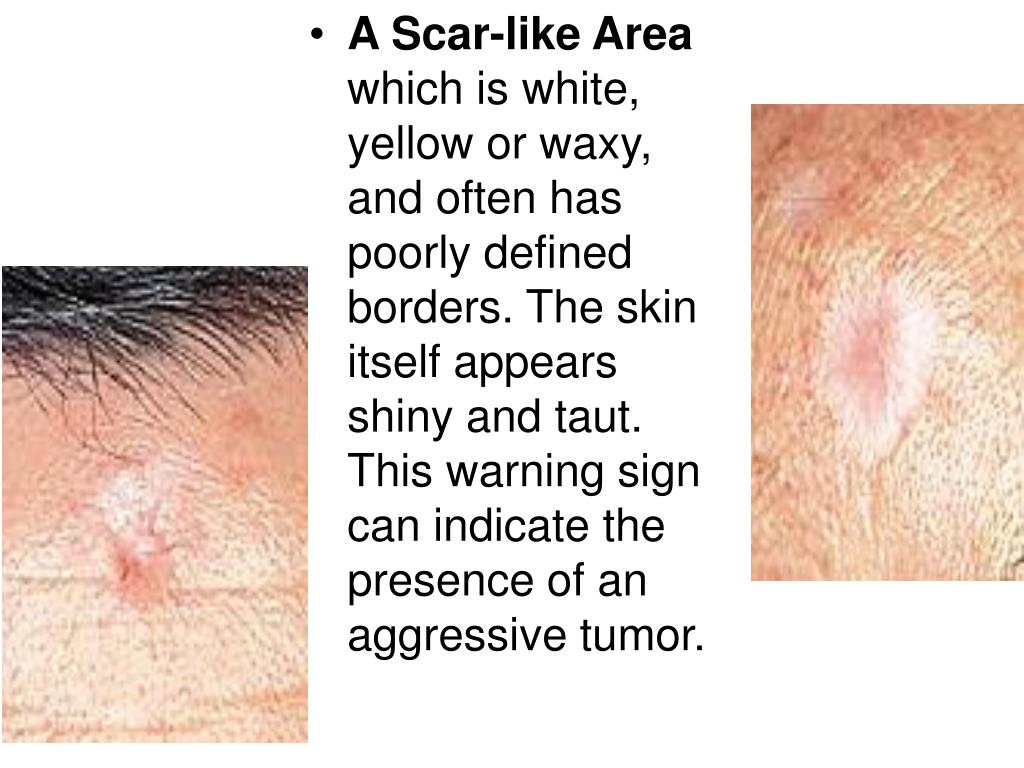 PPT - Skin Cancer PowerPoint Presentation, free download - ID:6252003