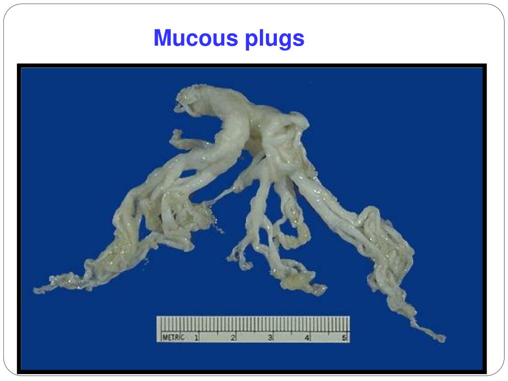 PPT - Diseases of the Respiratory System Lu hua PowerPoint Presentation ...