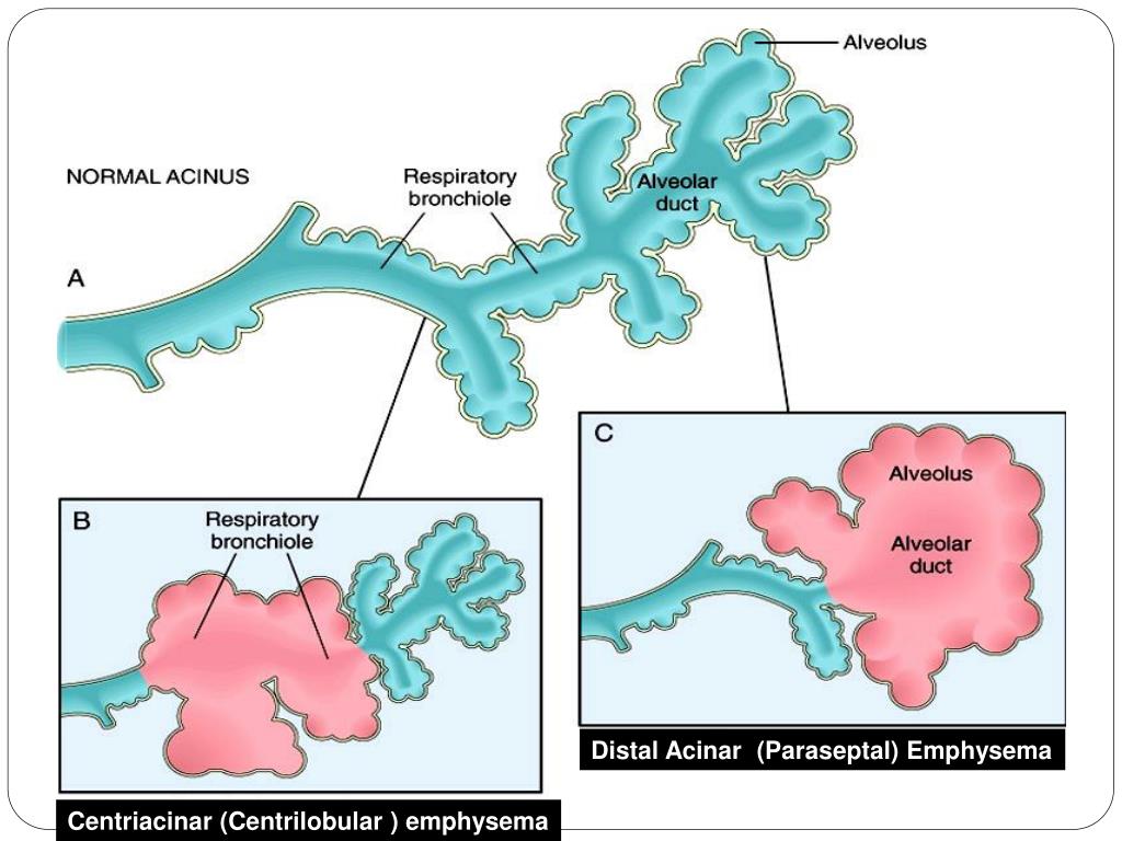 PPT - Diseases of the Respiratory System Lu hua PowerPoint Presentation ...