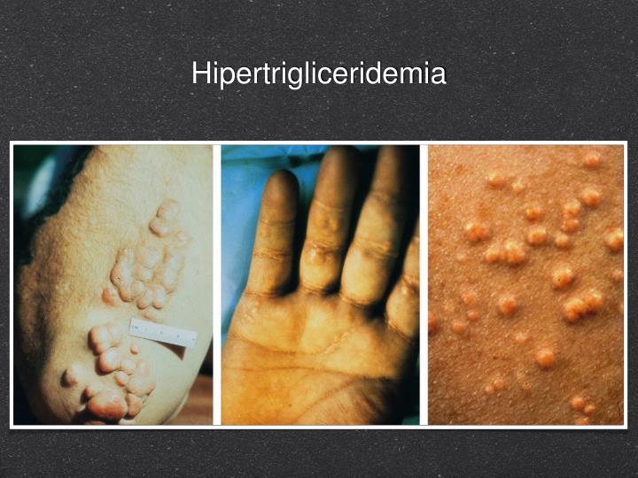 PPT - Dislipidemia PowerPoint Presentation - ID:6259319