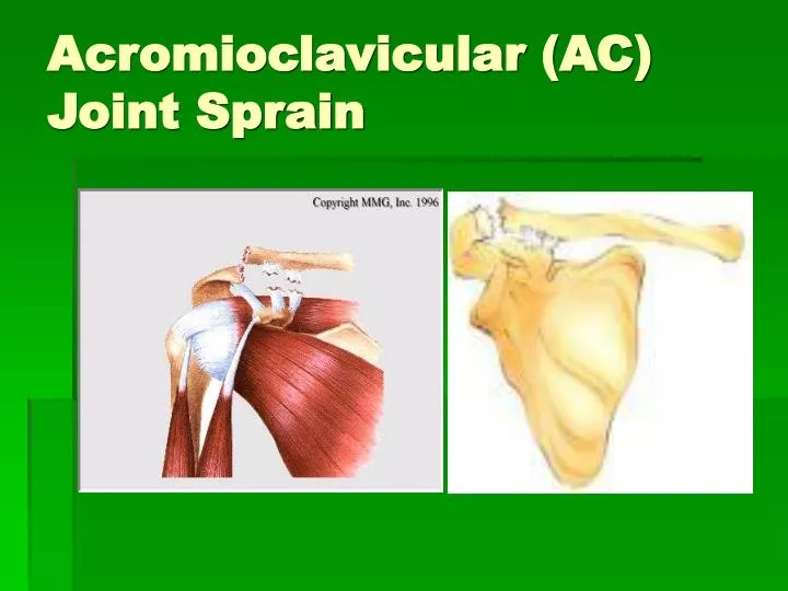 PPT - Acromioclavicular (AC) Joint Sprain PowerPoint Presentation, free ...