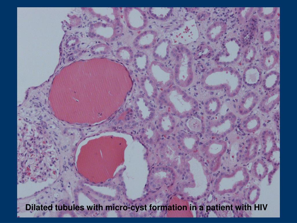 Ppt Hiv Associated Renal Disease Powerpoint Presentation Free Download Id6263988