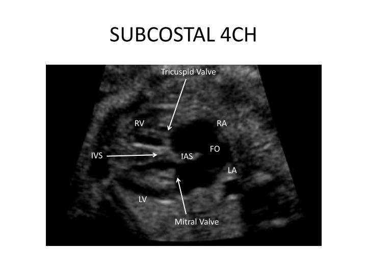 PPT - Fetal Heart Project PowerPoint Presentation - ID:6274427