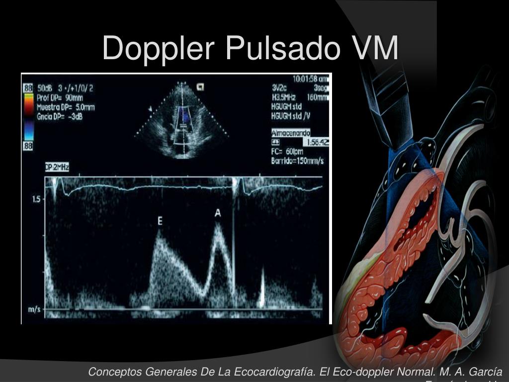 PPT - ECOCARDIOGRAFIA PARA ANESTESIOLOGOS PowerPoint Presentation, free ...