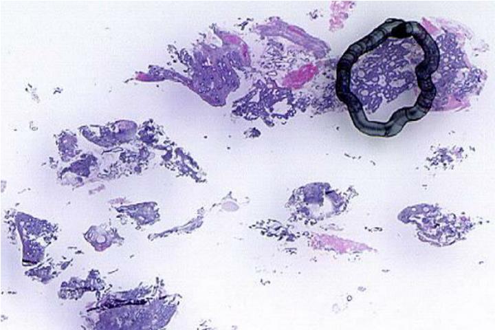 PPT - EIN (Endometrial Intraepithelial Neoplasia) and Ambiguous ...