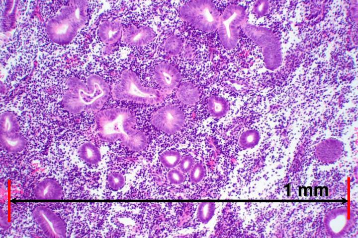 PPT - EIN (Endometrial Intraepithelial Neoplasia) and Ambiguous ...