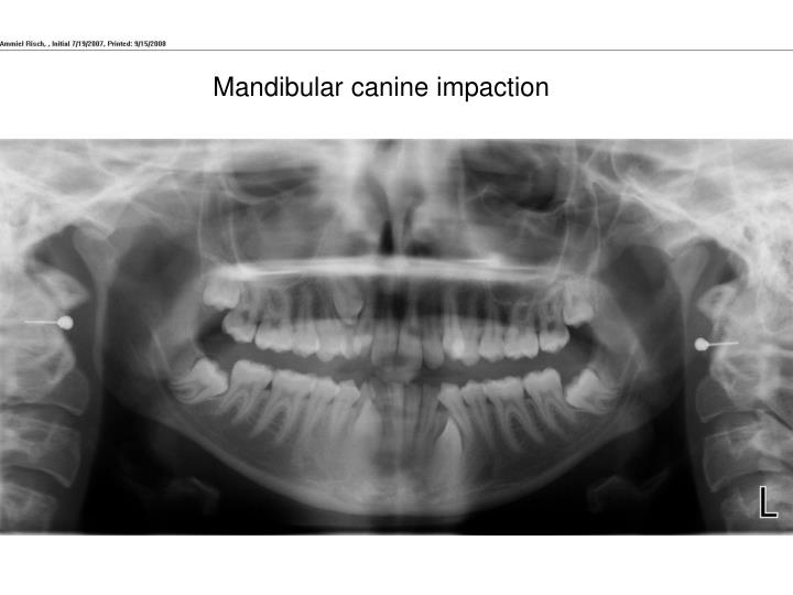 PPT - Canine Impactions Ectopic Eruption PowerPoint Presentation - ID ...