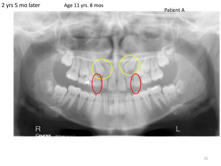 PPT - Canine Impactions Ectopic Eruption PowerPoint Presentation - ID ...
