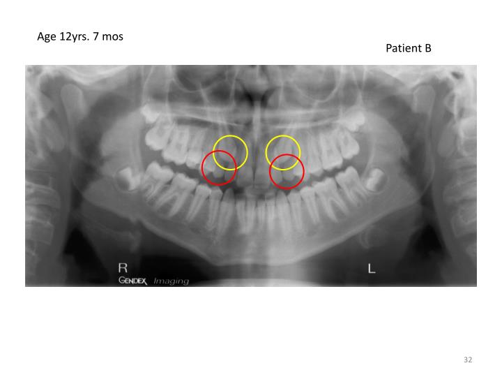 PPT - Canine Impactions Ectopic Eruption PowerPoint Presentation - ID ...
