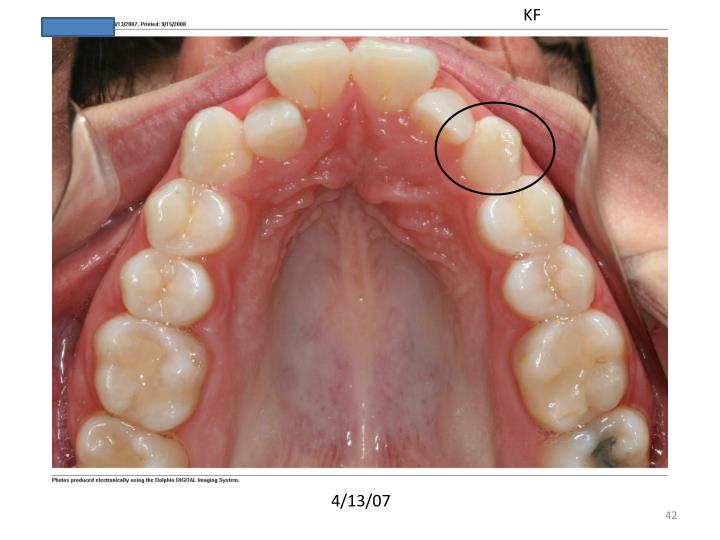 PPT - Canine Impactions Ectopic Eruption PowerPoint Presentation - ID ...