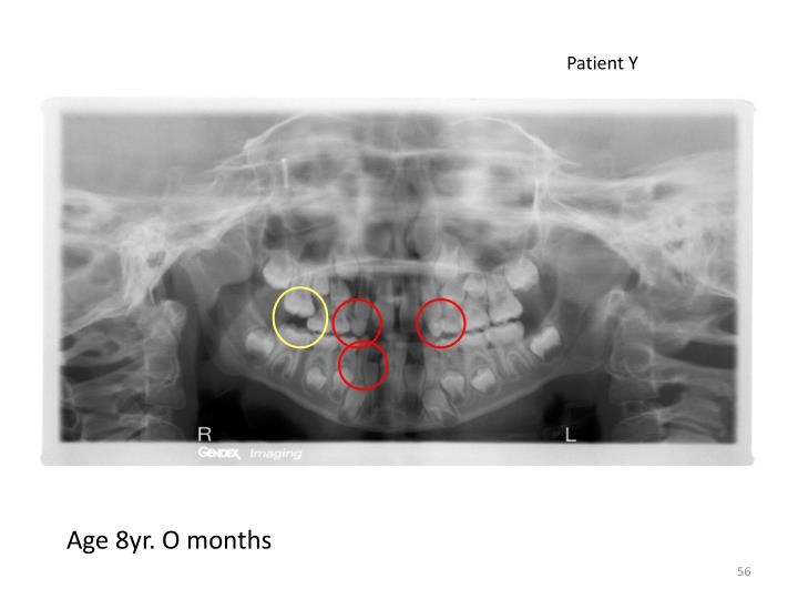PPT - Canine Impactions Ectopic Eruption PowerPoint Presentation - ID ...