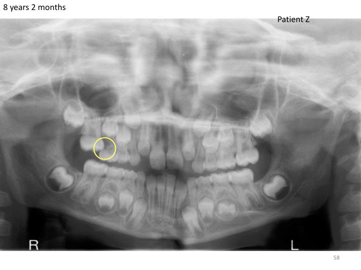 PPT - Canine Impactions Ectopic Eruption PowerPoint Presentation - ID ...
