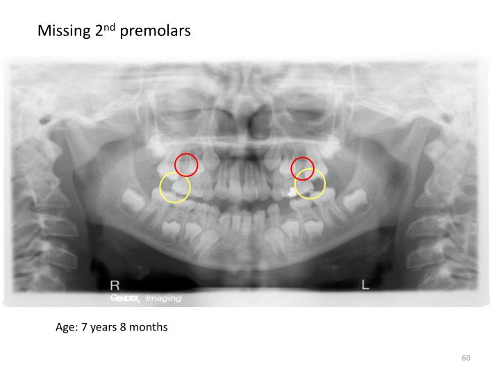 PPT - Canine Impactions Ectopic Eruption PowerPoint Presentation - ID ...