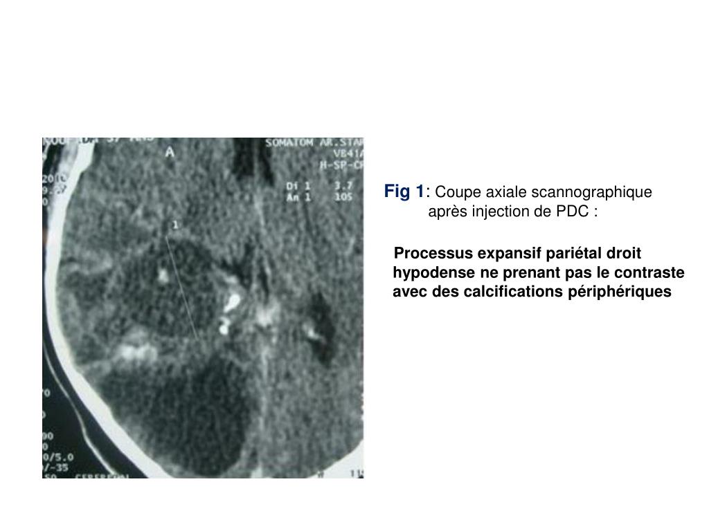 PPT - LYMPHANGIOME KYSTIQUE INTRACEREBRAL : A PROPOS D’UN CAS ...