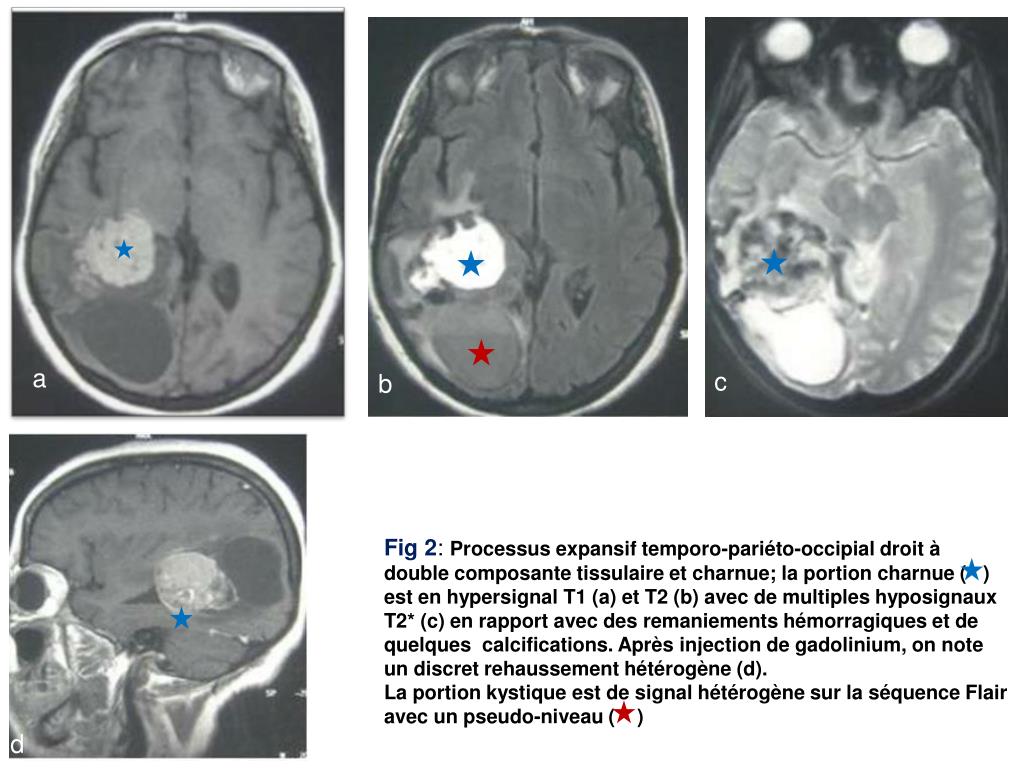 PPT - LYMPHANGIOME KYSTIQUE INTRACEREBRAL : A PROPOS D’UN CAS ...