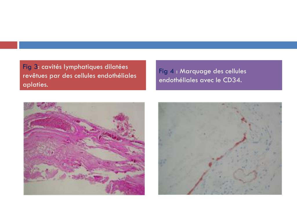 PPT - LYMPHANGIOME KYSTIQUE INTRACEREBRAL : A PROPOS D’UN CAS ...