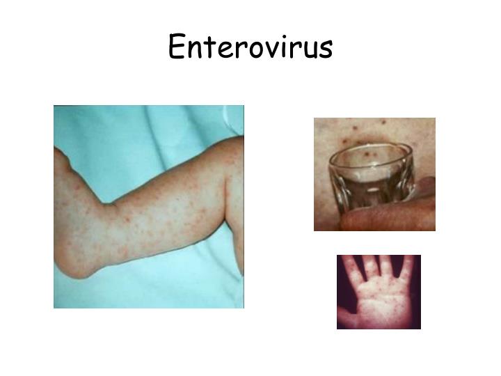 PPT - Fever and Rash PowerPoint Presentation - ID:6320033