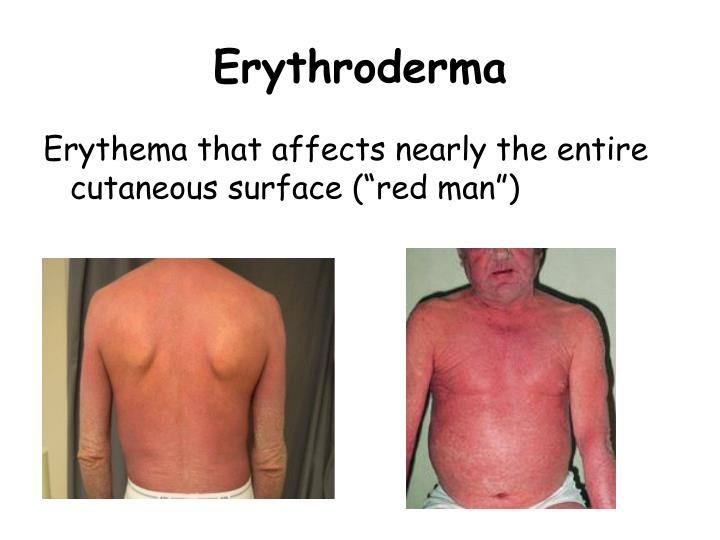 PPT - Fever and Rash PowerPoint Presentation - ID:6320033