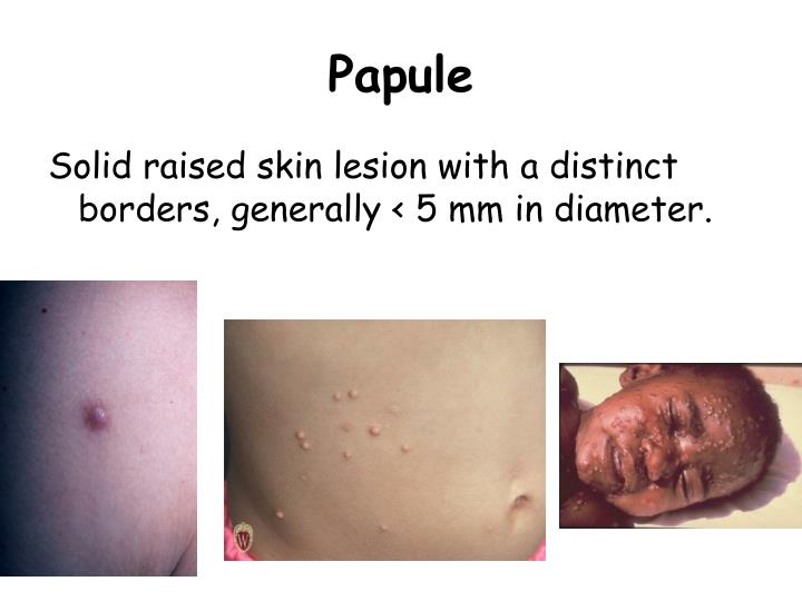 PPT - Fever and Rash PowerPoint Presentation - ID:6320033