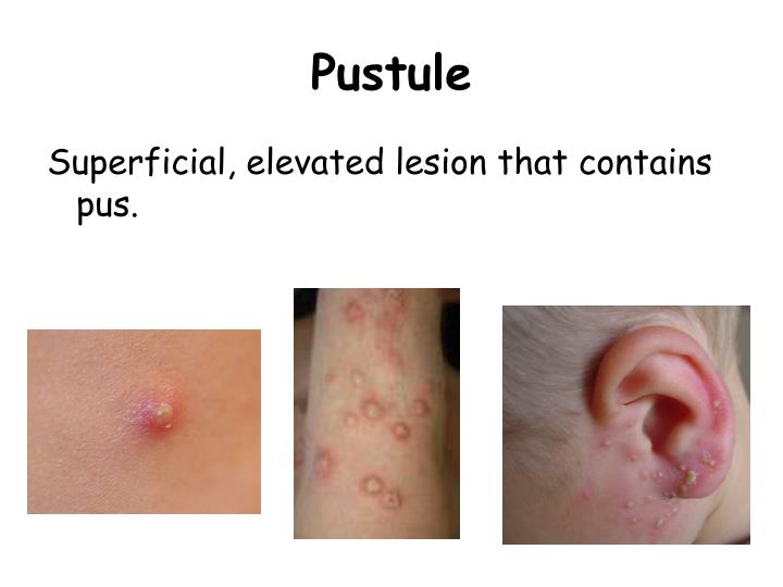 PPT - Fever and Rash PowerPoint Presentation - ID:6320033