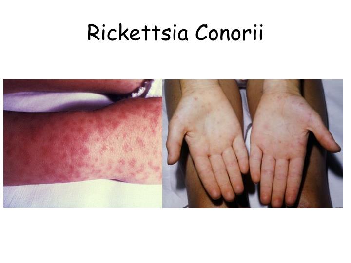 PPT - Fever and Rash PowerPoint Presentation - ID:6320033