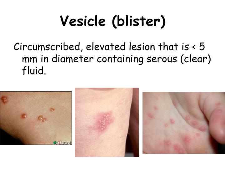 PPT - Fever and Rash PowerPoint Presentation - ID:6320033