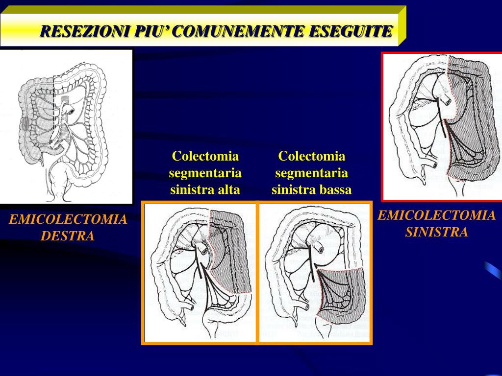 PPT - Semeiotica Chirurgica Carcinoma del colon- retto PowerPoint ...