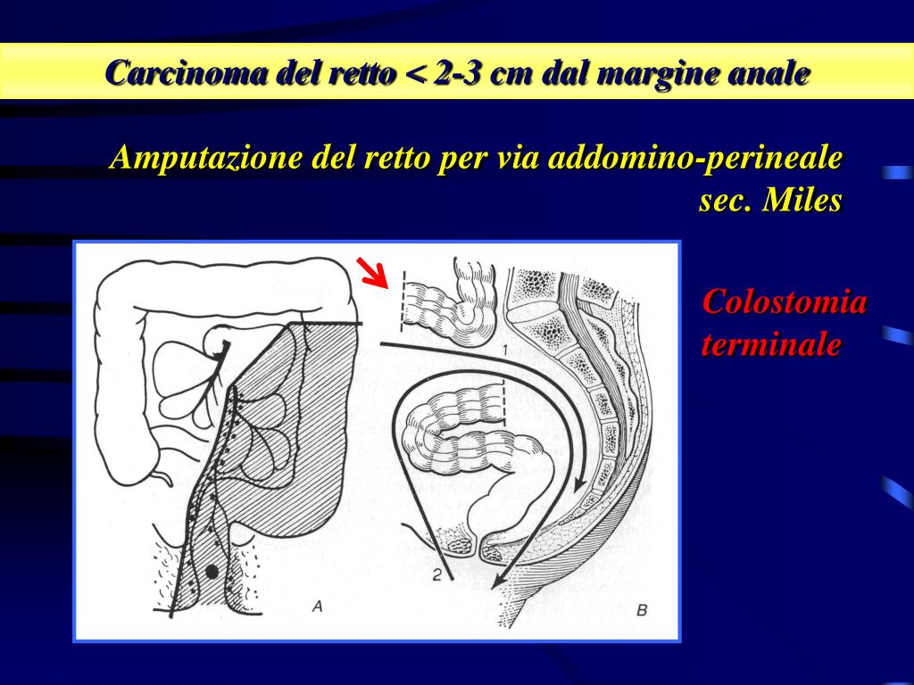 PPT - Semeiotica Chirurgica Carcinoma del colon- retto PowerPoint ...