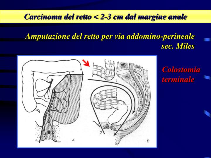 PPT - Semeiotica Chirurgica Carcinoma del colon- retto PowerPoint ...