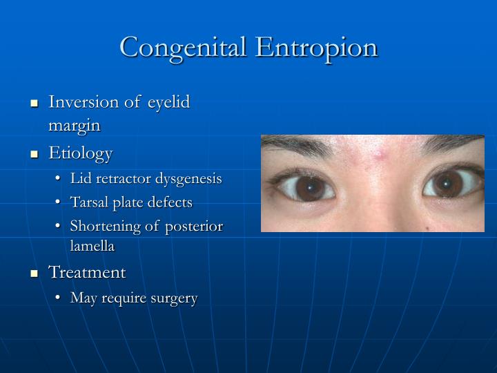 PPT - Congenital Eyelid Disorders PowerPoint Presentation - ID:6326593