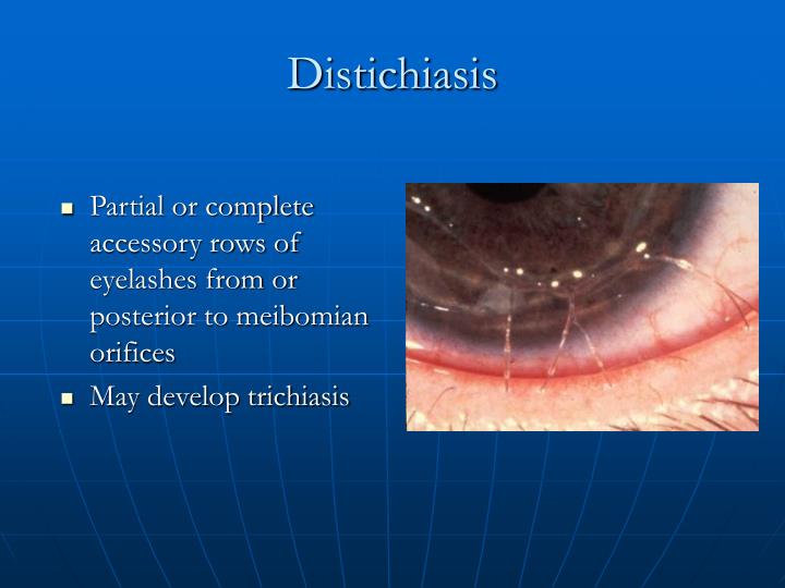 PPT - Congenital Eyelid Disorders PowerPoint Presentation - ID:6326593