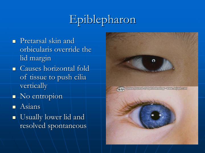 PPT - Congenital Eyelid Disorders PowerPoint Presentation - ID:6326593
