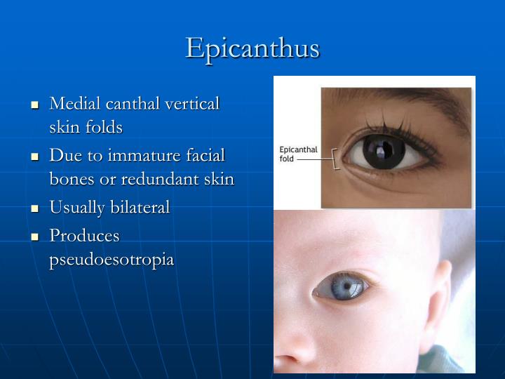 PPT - Congenital Eyelid Disorders PowerPoint Presentation - ID:6326593