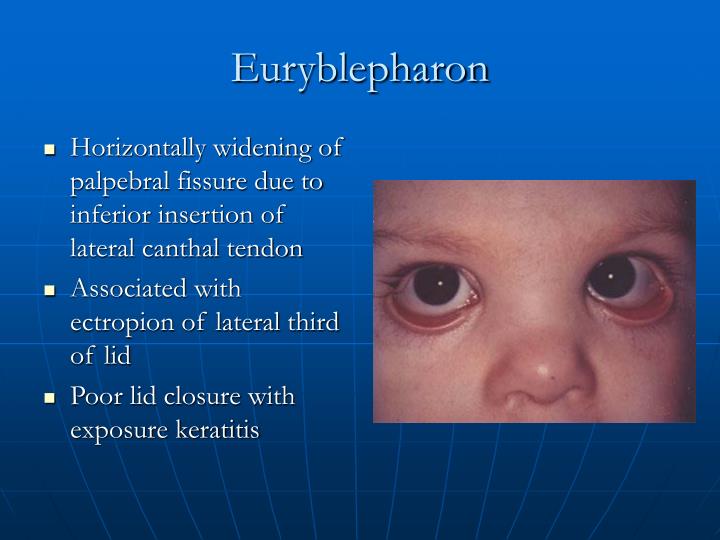 PPT - Congenital Eyelid Disorders PowerPoint Presentation - ID:6326593