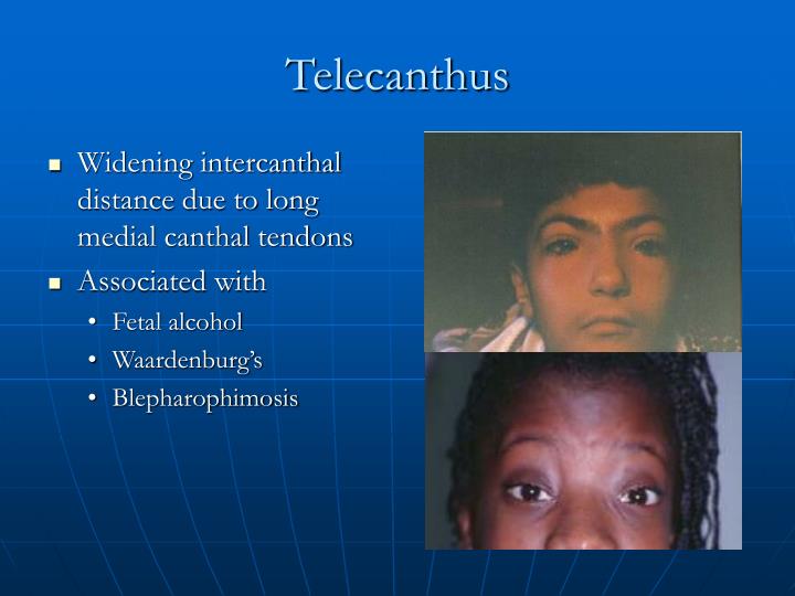 PPT - Congenital Eyelid Disorders PowerPoint Presentation - ID:6326593