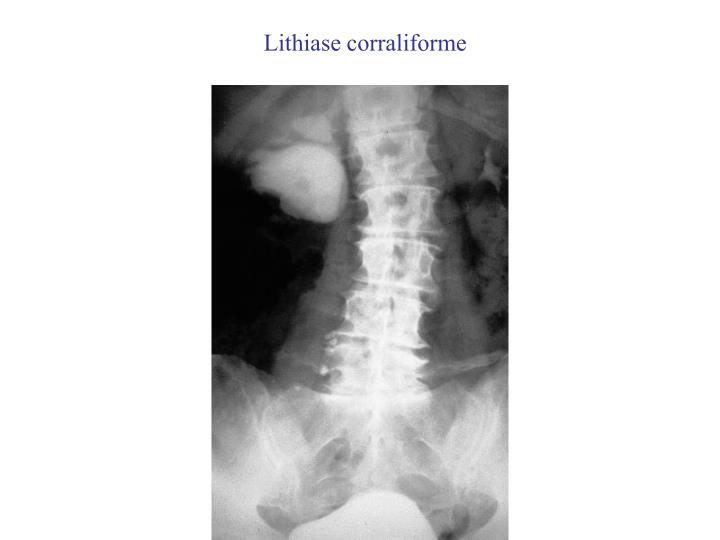 PPT - Exploration d’une lithiase urinaire PowerPoint Presentation - ID ...