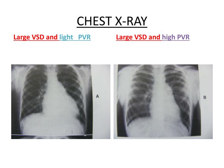 PPT - VENTRICULAR SEPTAL DEFECT (VSD) PowerPoint Presentation - ID:6330625