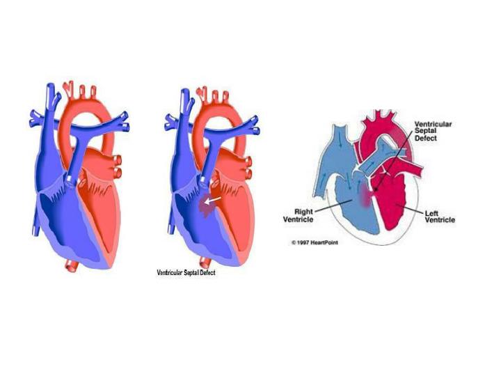 PPT - VENTRICULAR SEPTAL DEFECT (VSD) PowerPoint Presentation - ID:6330625