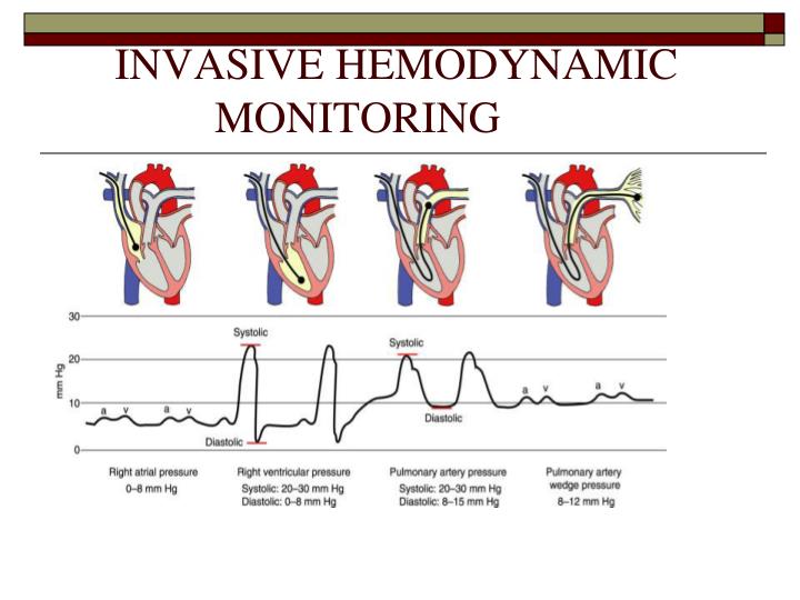 PPT - INVASIVE HEMODYNAMIC MONITORING PowerPoint Presentation - ID:6333249 PPT - INVASIVE HEMODYNAMIC MONITORING PowerPoint Presentation - ID:6333249