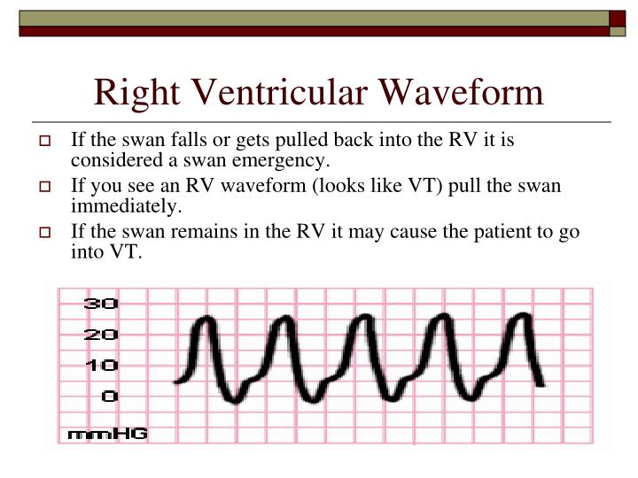 Right Ventricular Pressure Waveform Right Ventricular Pressure Waveform