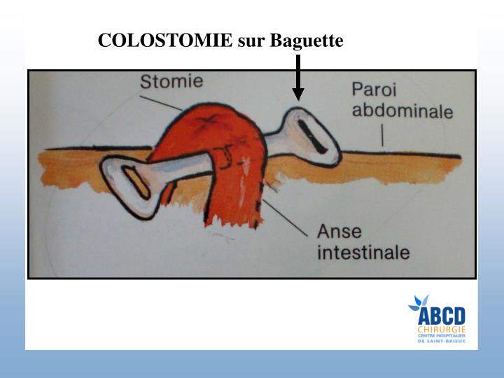PPT - CICATRISATION EN CHIRURGIE DIGESTIVE PowerPoint Presentation - ID ...