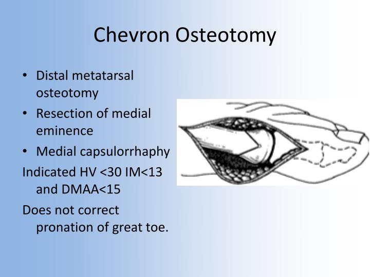 PPT - Hallux Valgus; the wrath of fancy shoes PowerPoint Presentation ...