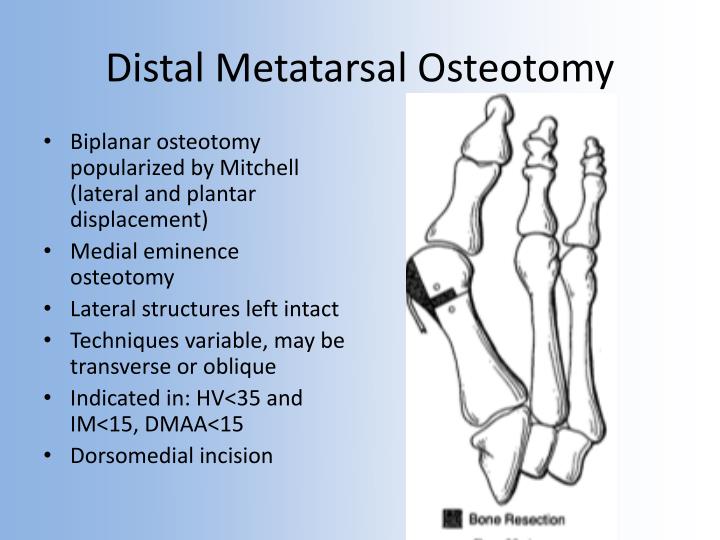 PPT - Hallux Valgus; the wrath of fancy shoes PowerPoint Presentation ...